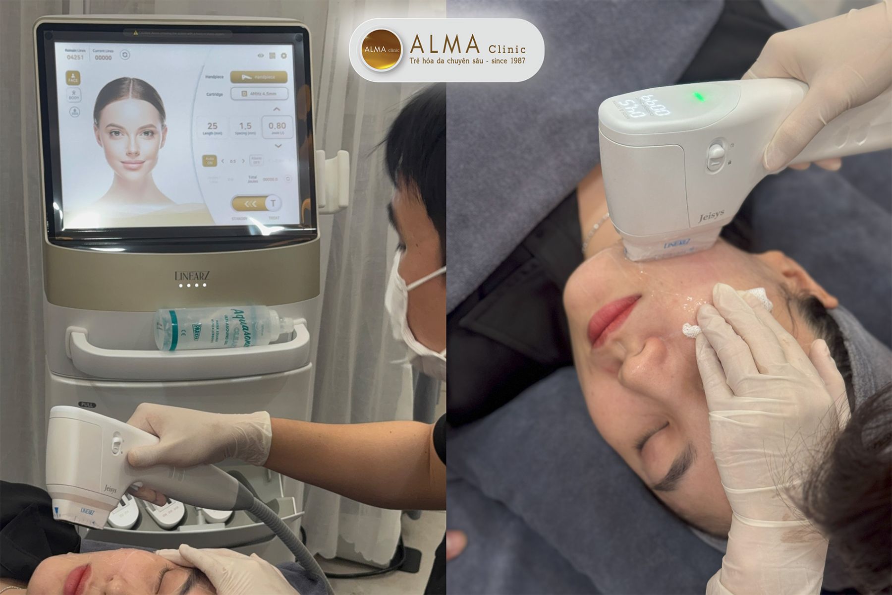 Linear Z - Giải pháp nâng cơ an toàn cho làn da khỏe đẹp